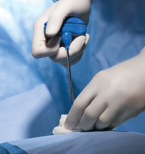 TJC6011 • BD® T-handle Jamshidi™ Crown Bone Marrow Biopsy/Aspiration ...